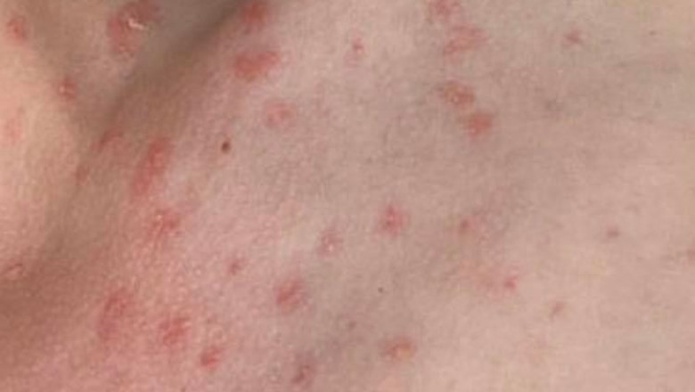 Psoriasis not contagious, must not cause stigma | News Fort - Your ...